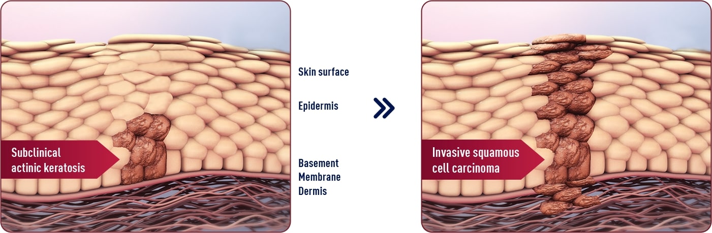 Dangers of actinic keratosis (AK) – AMELUZ® and BF-RhodoLED®