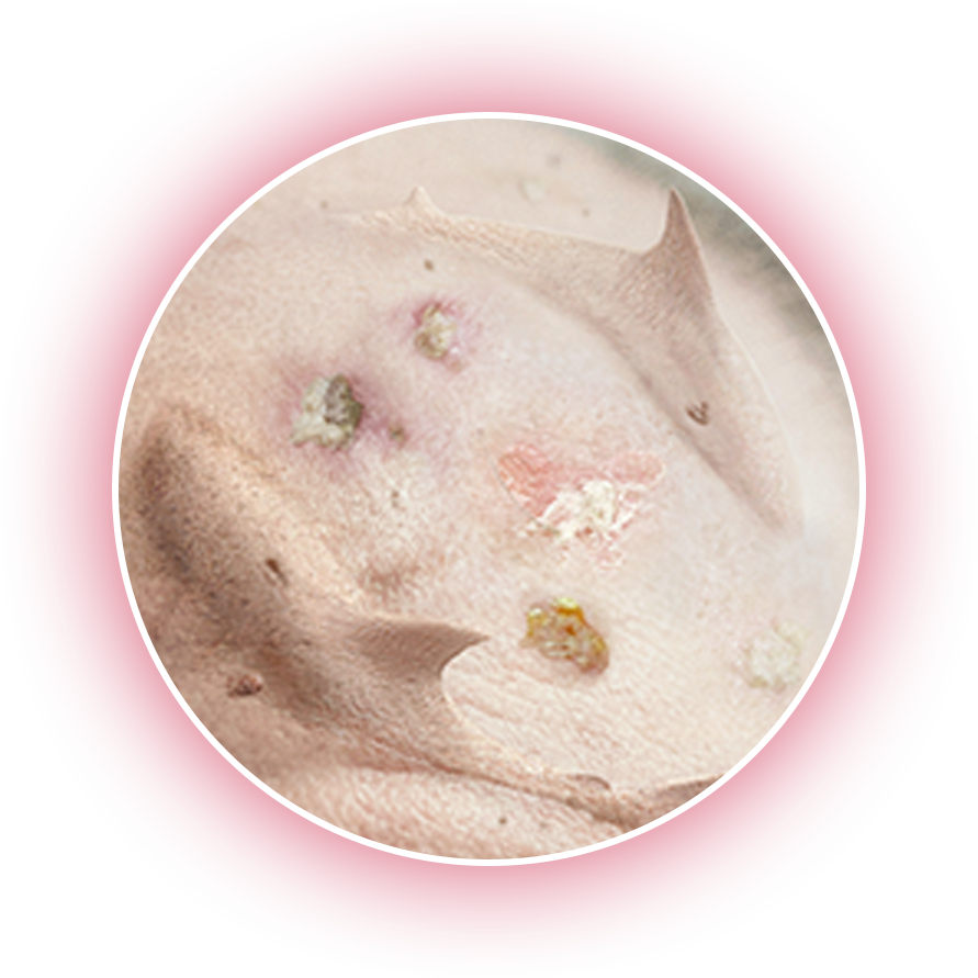 Dangers of actinic keratosis (AK) – AMELUZ® and BF-RhodoLED®