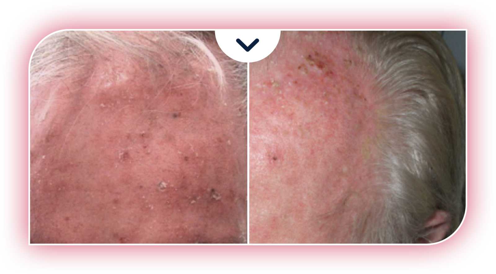 Dangers of actinic keratosis (AK) – AMELUZ® and BF-RhodoLED®