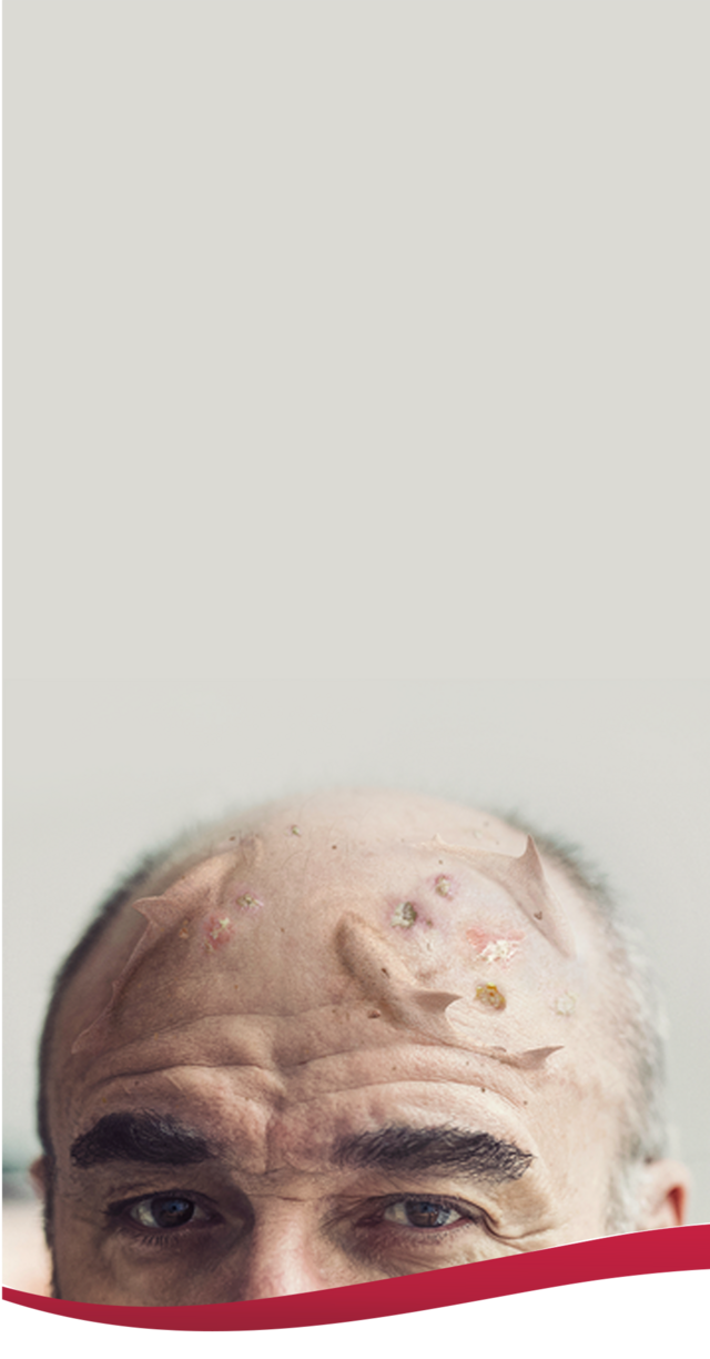 AMELUZ and BF-RhodoLED® treat actinic keratosis (AK)