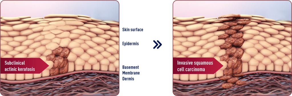 Dangers of actinic keratosis (AK) – AMELUZ® and BF-RhodoLED®