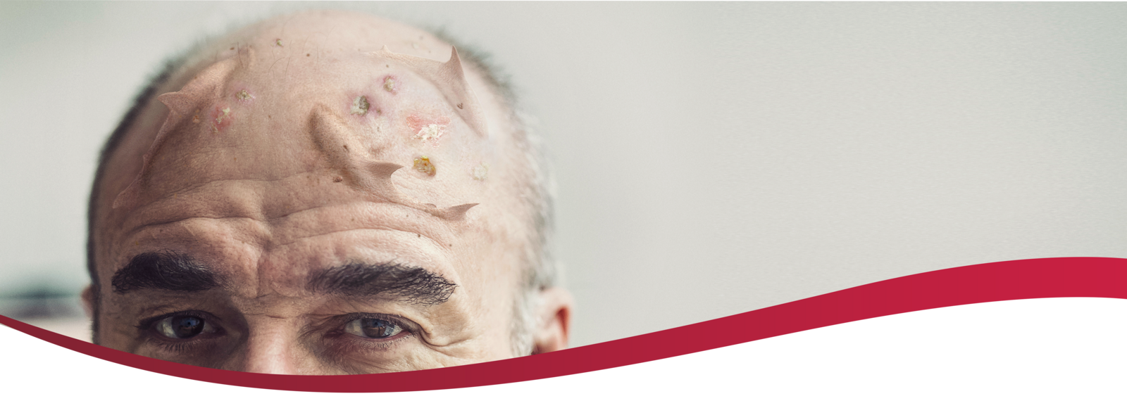 AMELUZ and BF-RhodoLED® treat actinic keratosis (AK)