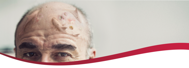 AMELUZ and BF-RhodoLED® treat actinic keratosis (AK)