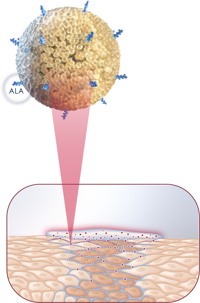 Nanoemulsion offers enhanced penetration – AMELUZ® and BF-RhodoLED®