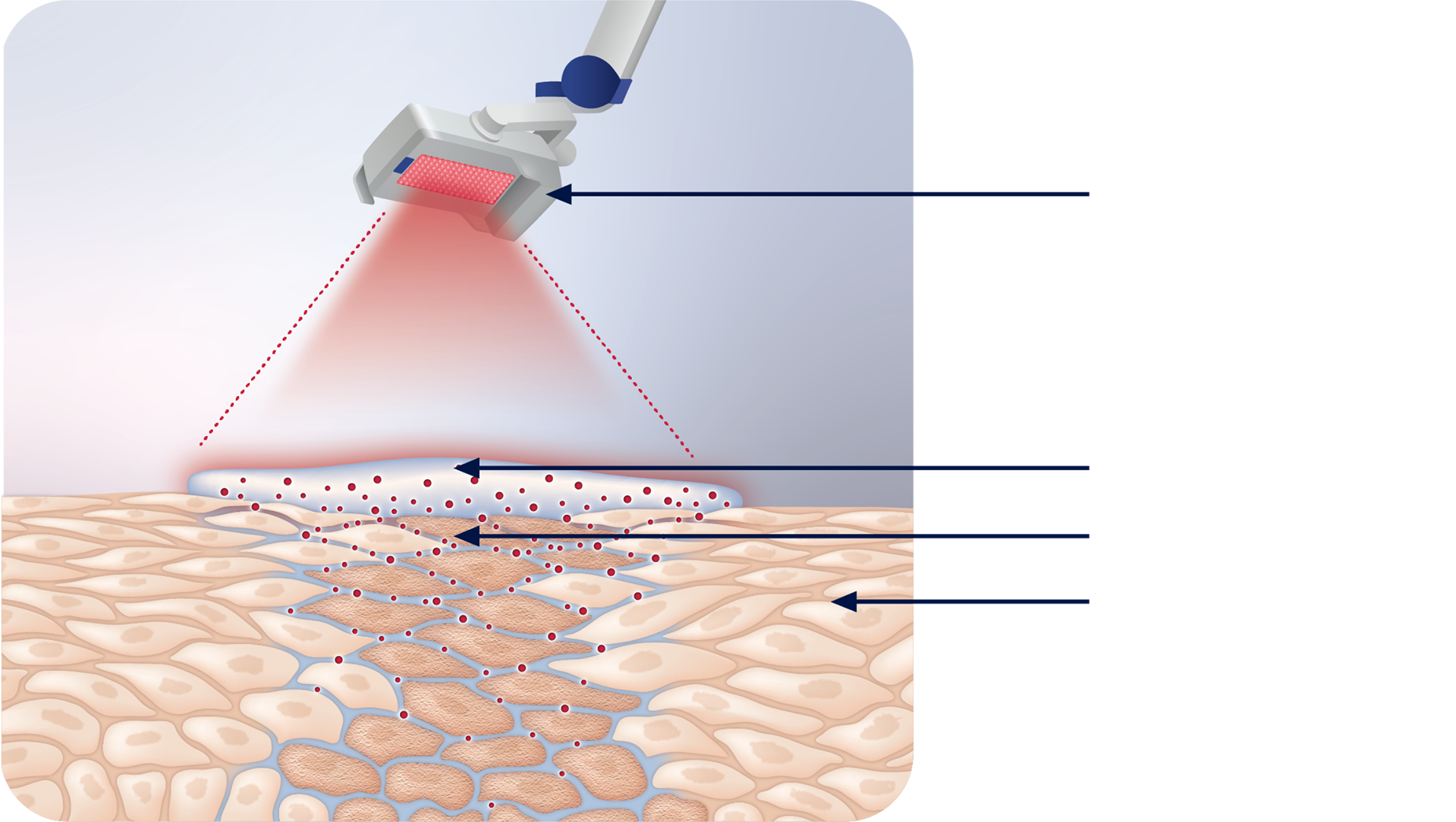 Choose a therapy that treats the field – AMELUZ® and BF-RhodoLED®