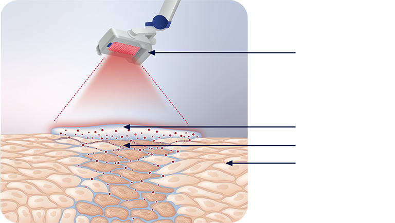 Choose a therapy that treats the field – AMELUZ® and BF-RhodoLED®