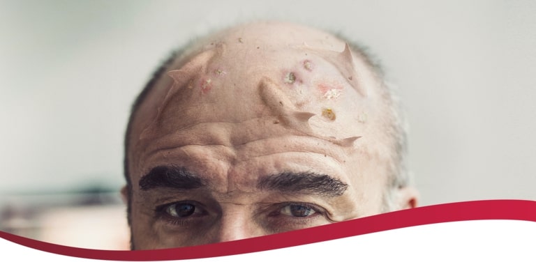 AMELUZ and BF-RhodoLED® treat actinic keratosis (AK)