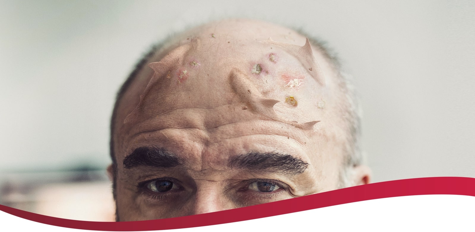 AMELUZ and BF-RhodoLED® treat actinic keratosis (AK)