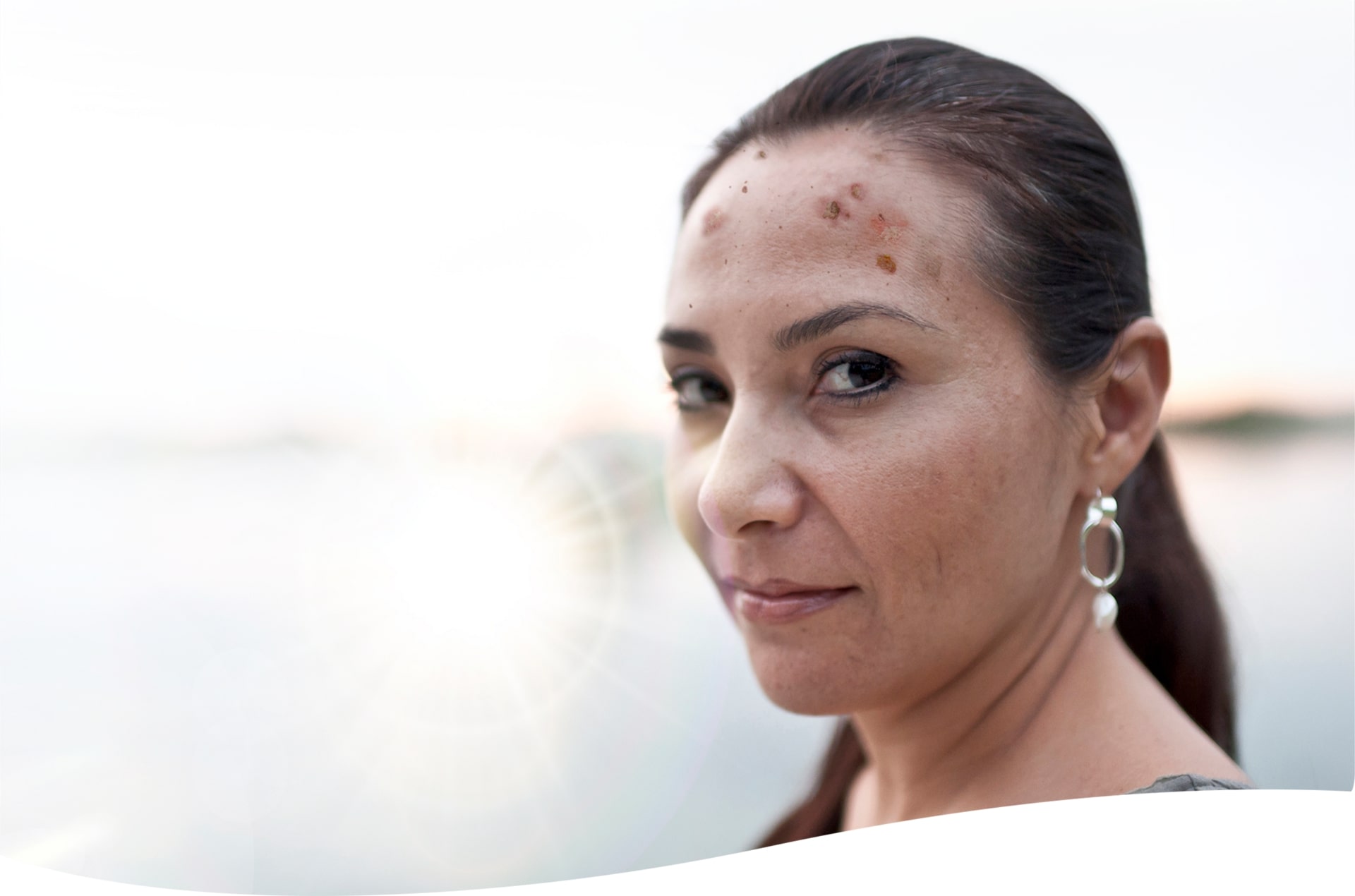 Dangers of actinic keratosis (AK) – AMELUZ® and BF-RhodoLED®